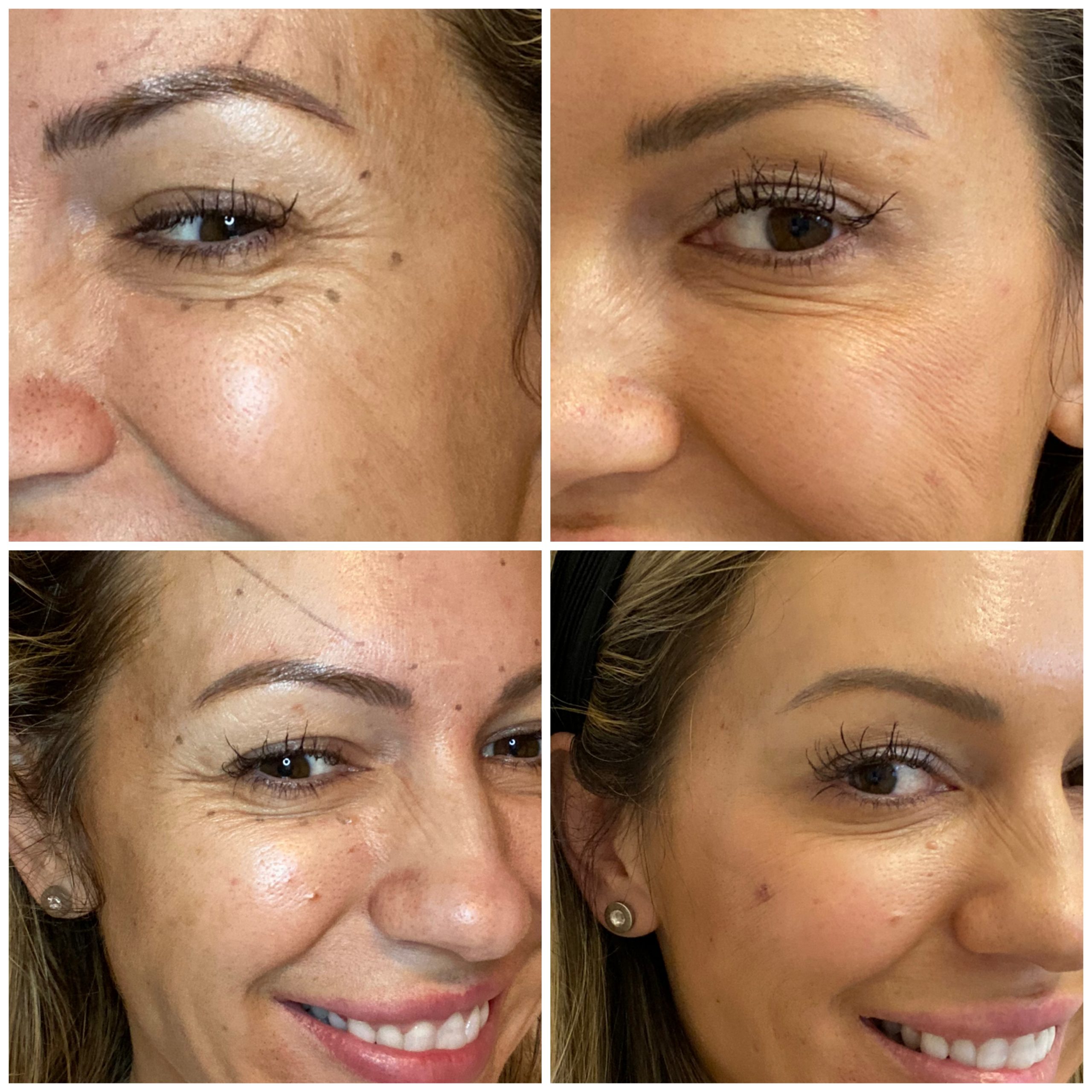 Botulinum toxin injections | Injection Queen