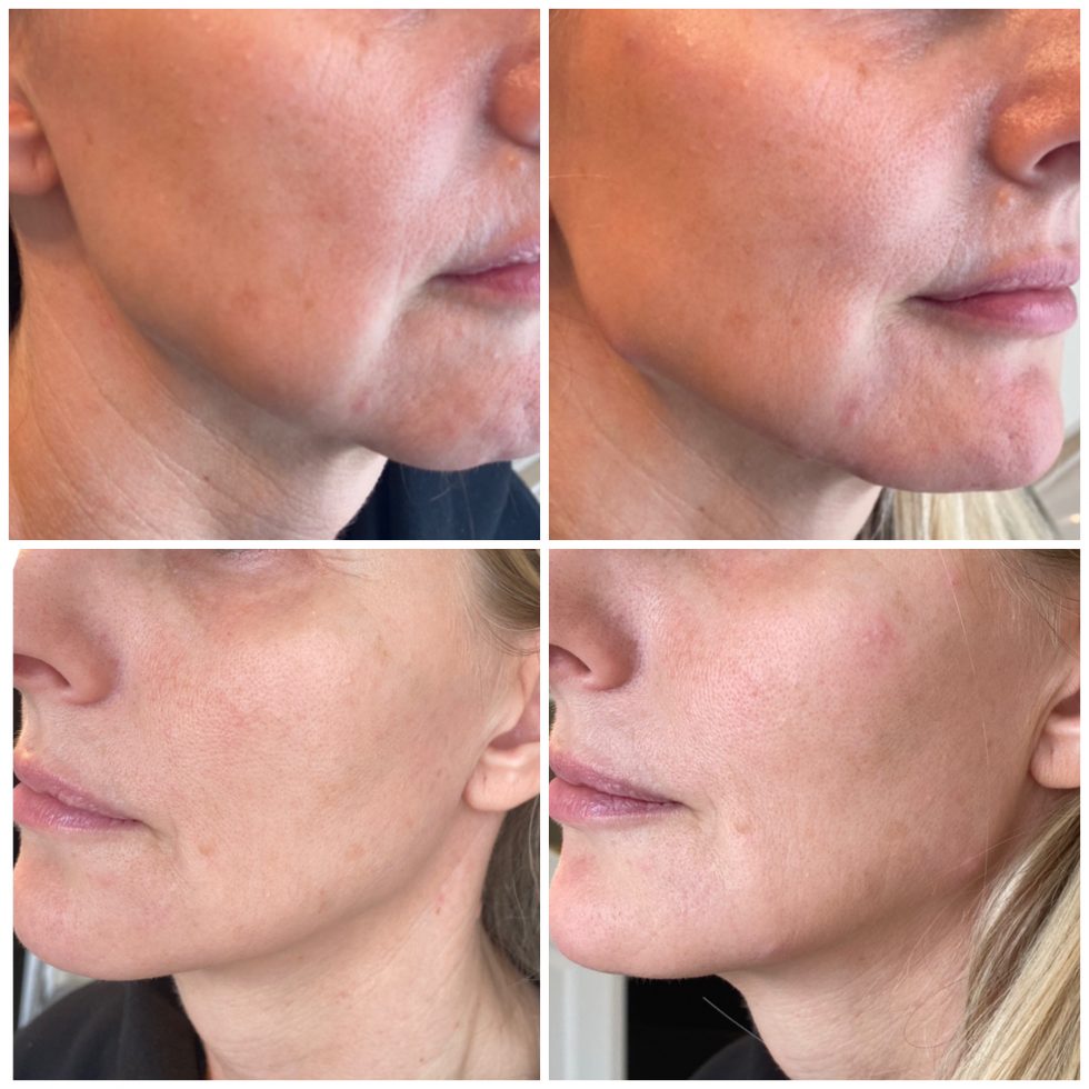 Jawline Filler | Injection Queen