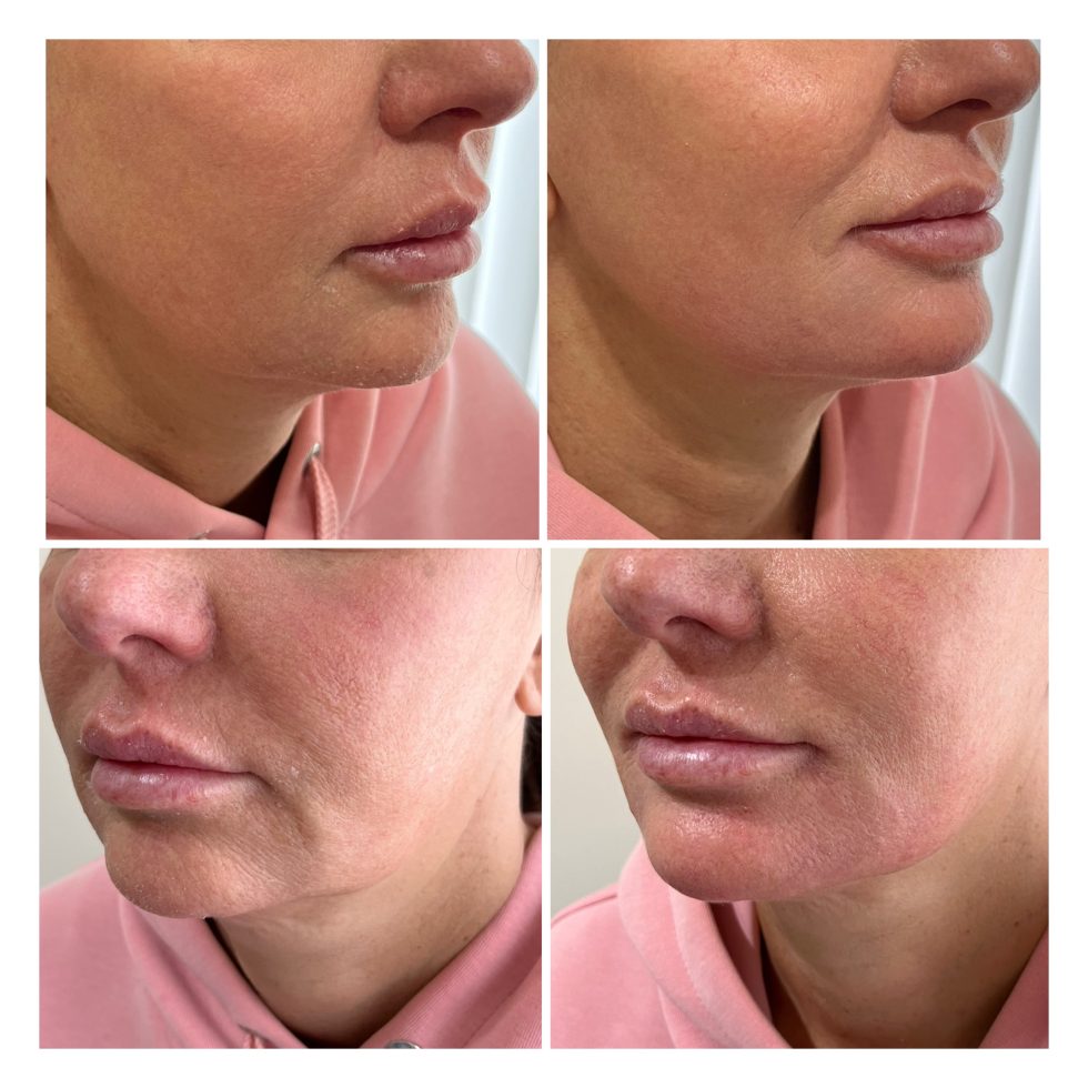 Jawline Filler | Injection Queen