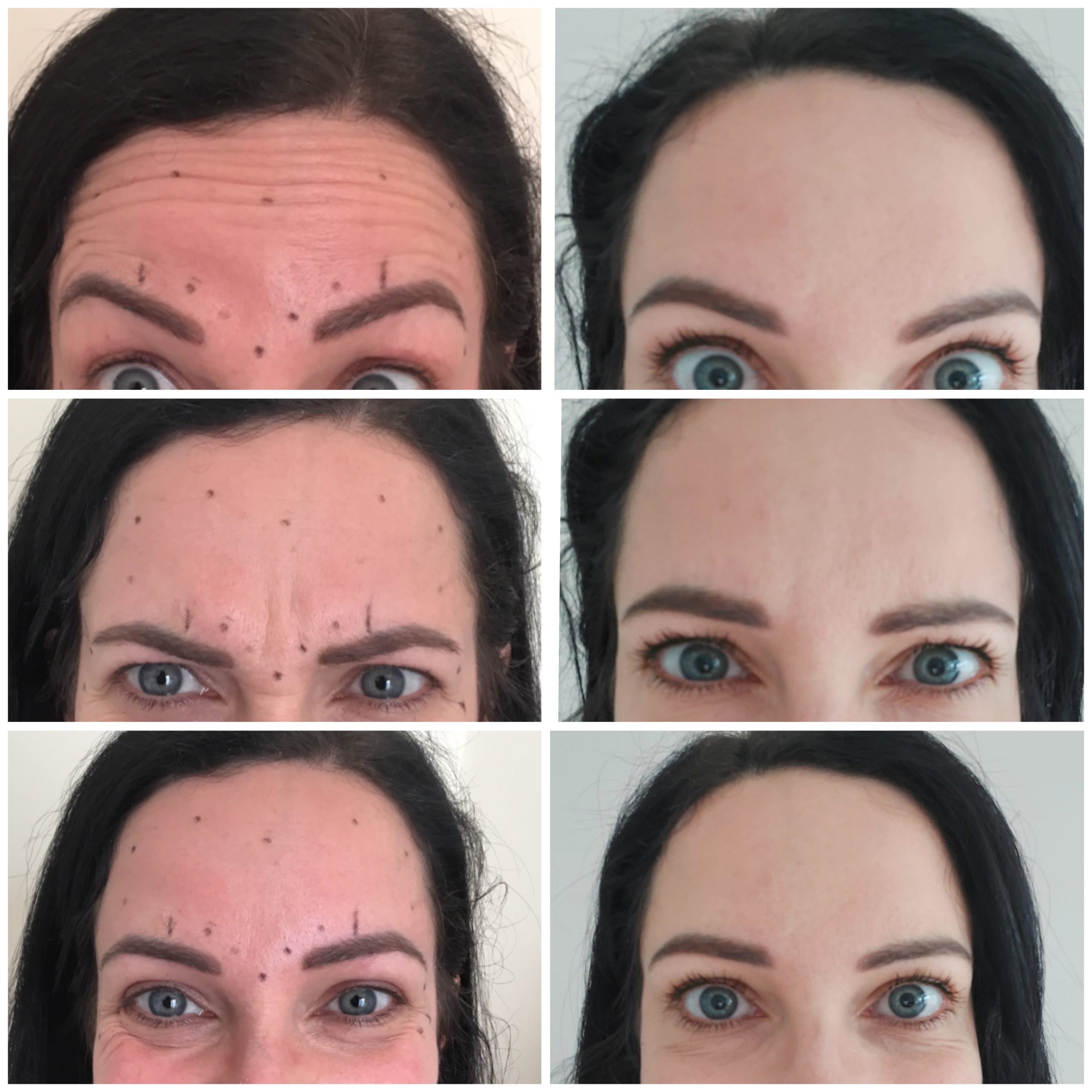 Botulinum toxin injections | Injection Queen